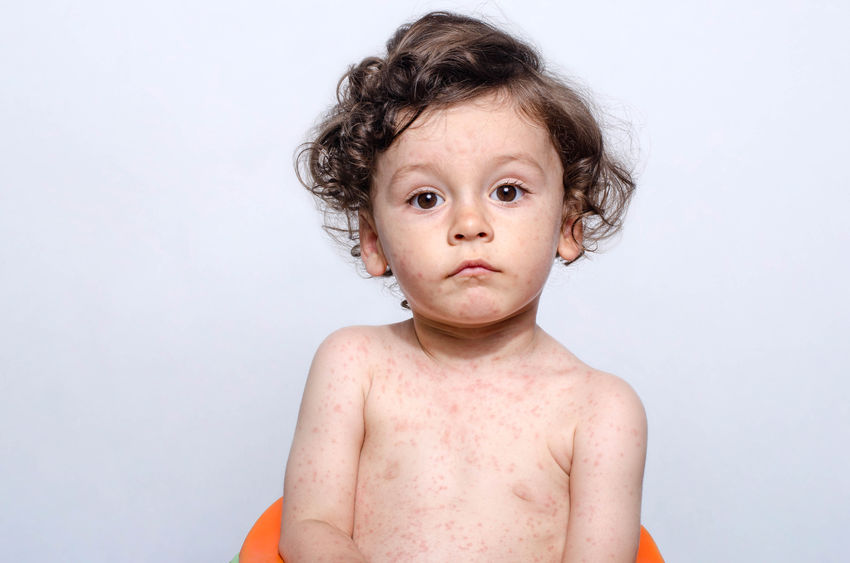 Name That Rash A Guide To Identifying Rashes In Kids Rainbow name-that-rash-a-guide-to-identifying-rashes-in-kids-rainbow